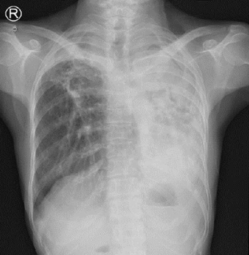 Computed tomography scan imaging in case of destroyed lung post ...